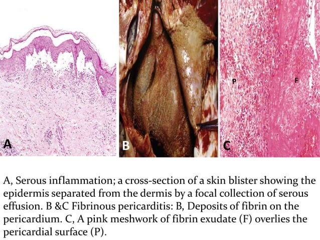 4._Morphologic_Patterns_&_Outcomes_of_Acute_Inflammation.pptx ...
