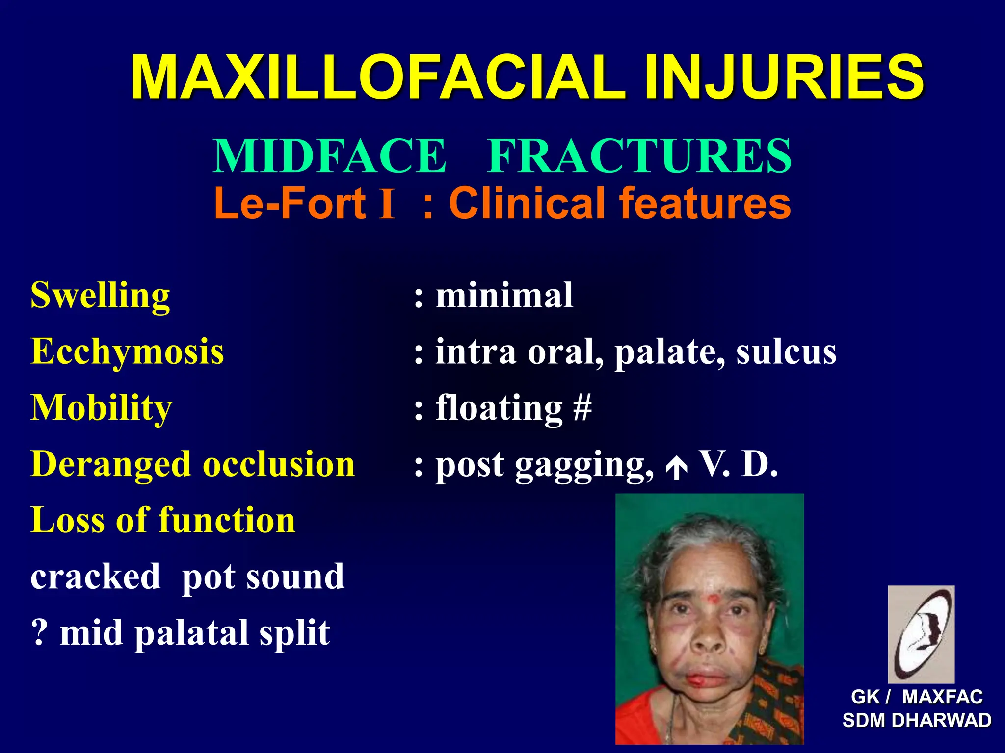 4. mid face fracture ppt for ug students | PPT