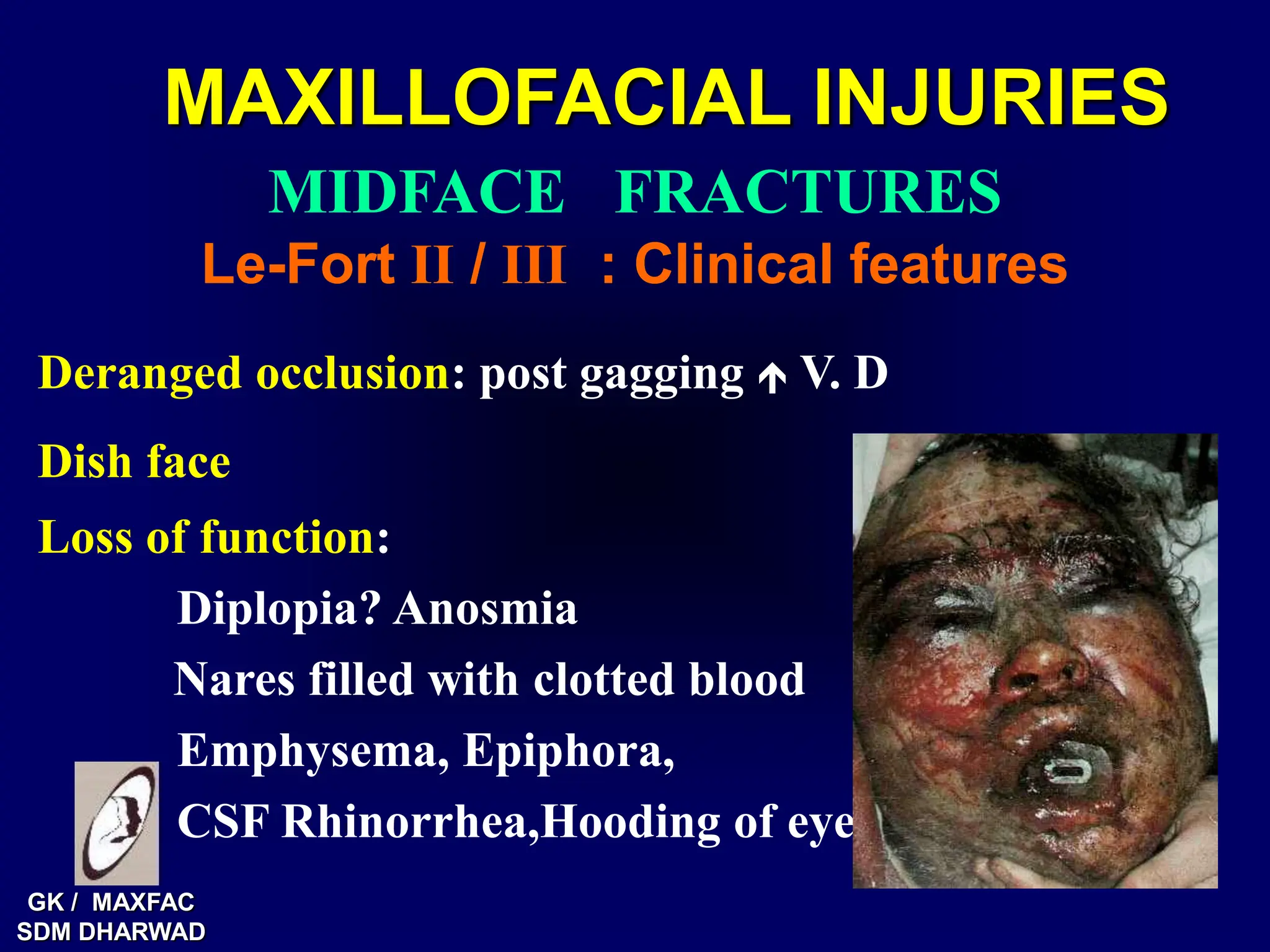 4. mid face fracture ppt for ug students | PPT