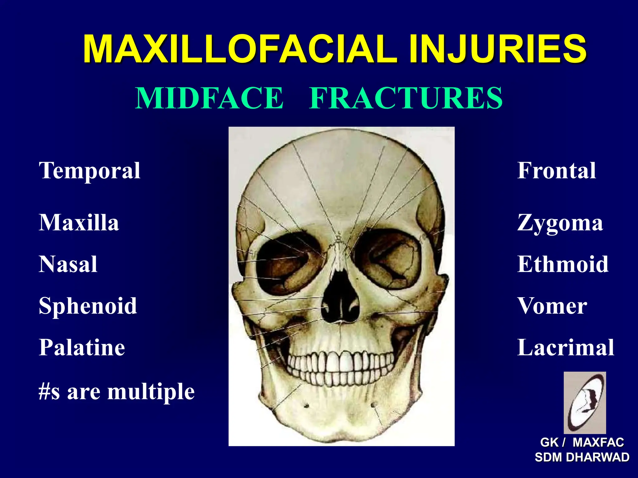 4. mid face fracture ppt for ug students | PPT