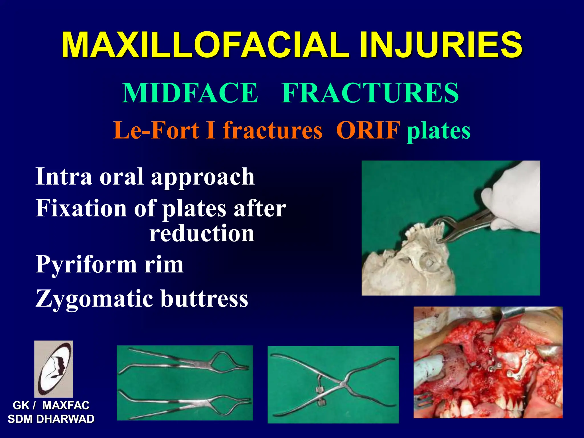 4. mid face fracture ppt for ug students | PPT