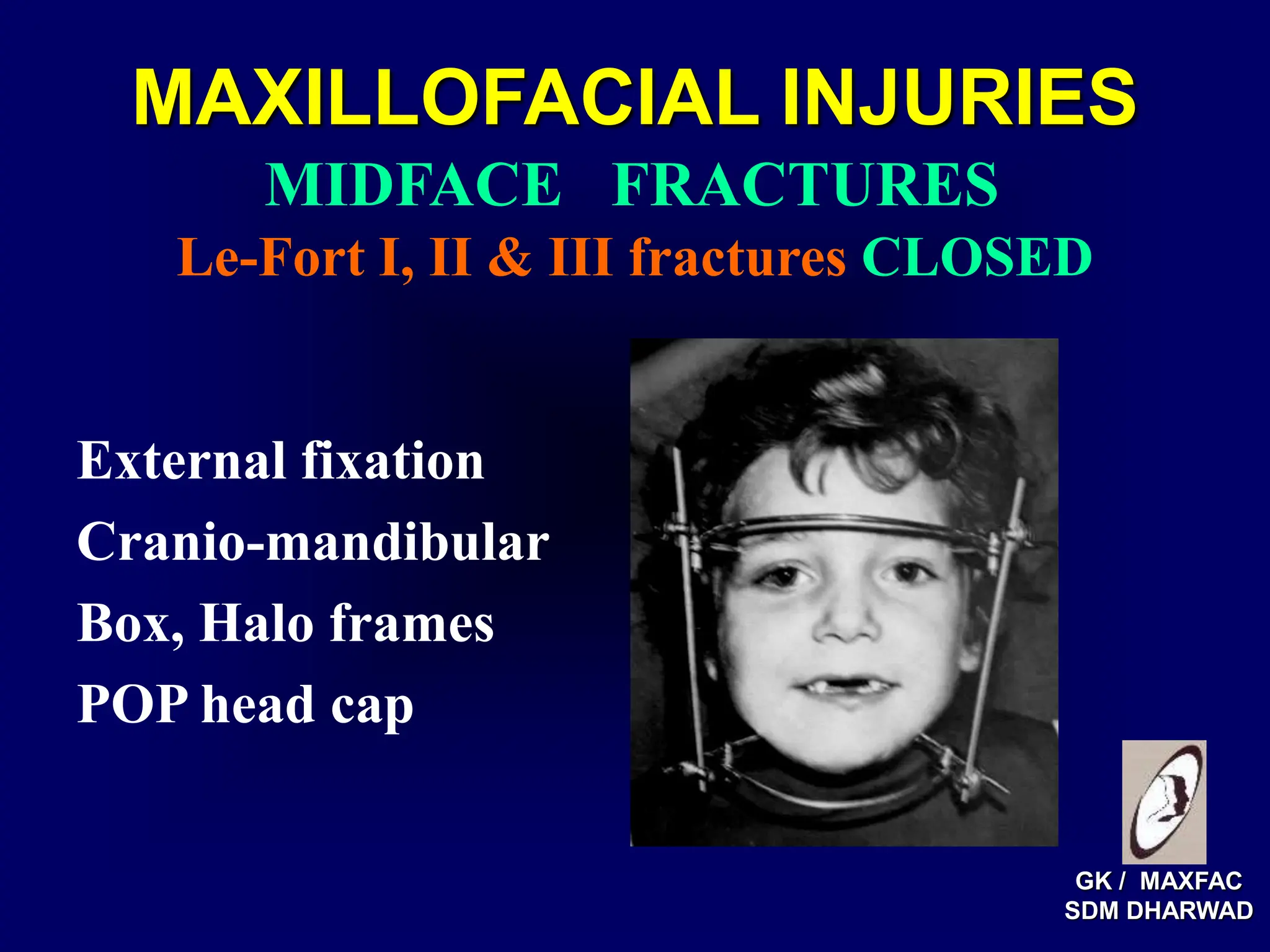 4. mid face fracture ppt for ug students | PPT