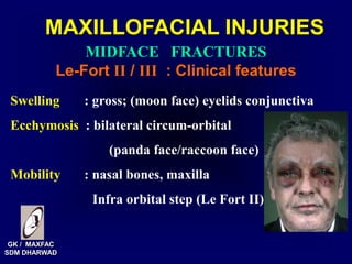 4. mid face fracture ppt for ug students | PPT