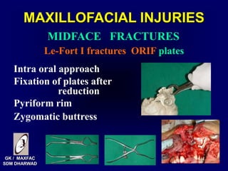 4. mid face fracture ppt for ug students | PPT | Death, Injury, or ...