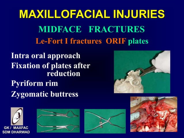 4. mid face fracture ppt for ug students | PPT | Death, Injury, or ...