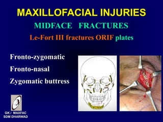 4. mid face fracture ppt for ug students | PPT | Death, Injury, or ...