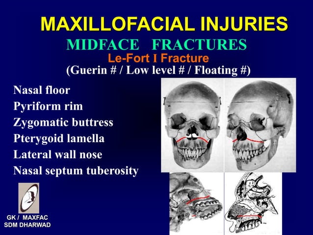 4. mid face fracture ppt for ug students | PPT | Death, Injury, or ...