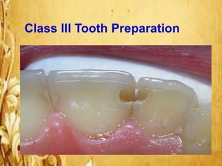 4. Composite cavity preparation (1).pptx