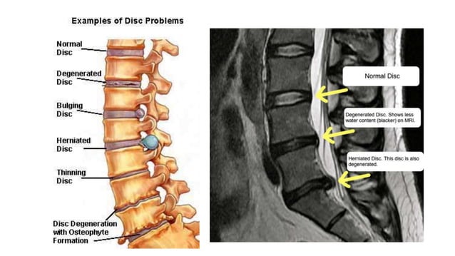 4. Degenerasi Diskus Intervertebral.pptx