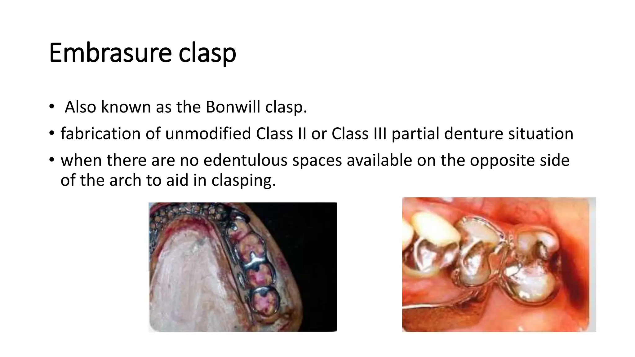 4. Direct Retainers and Indirect Retainers.pptx