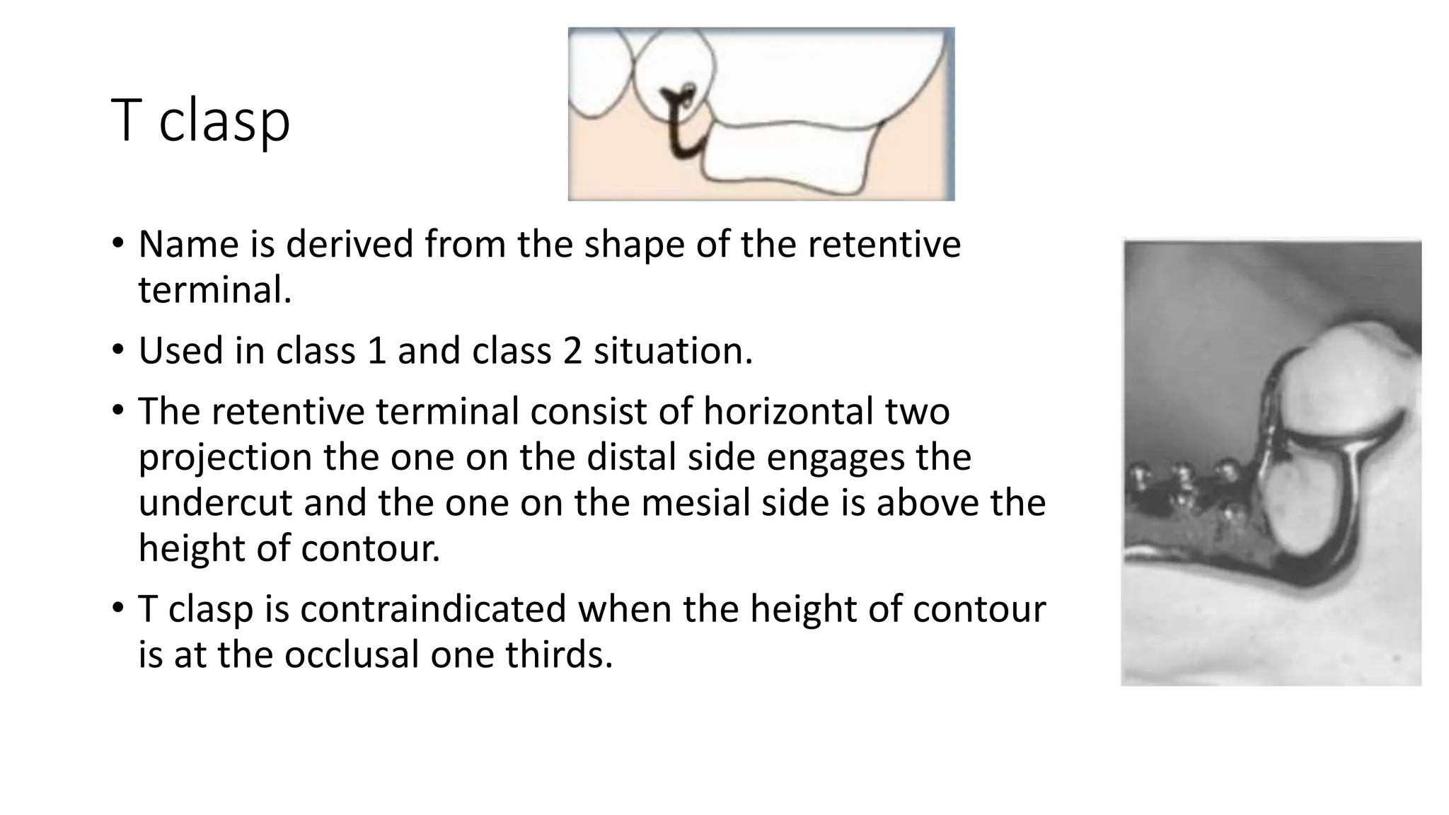 4. Direct Retainers and Indirect Retainers.pptx