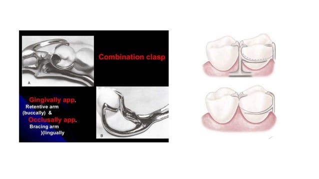 4. Direct Retainers and Indirect Retainers.pptx