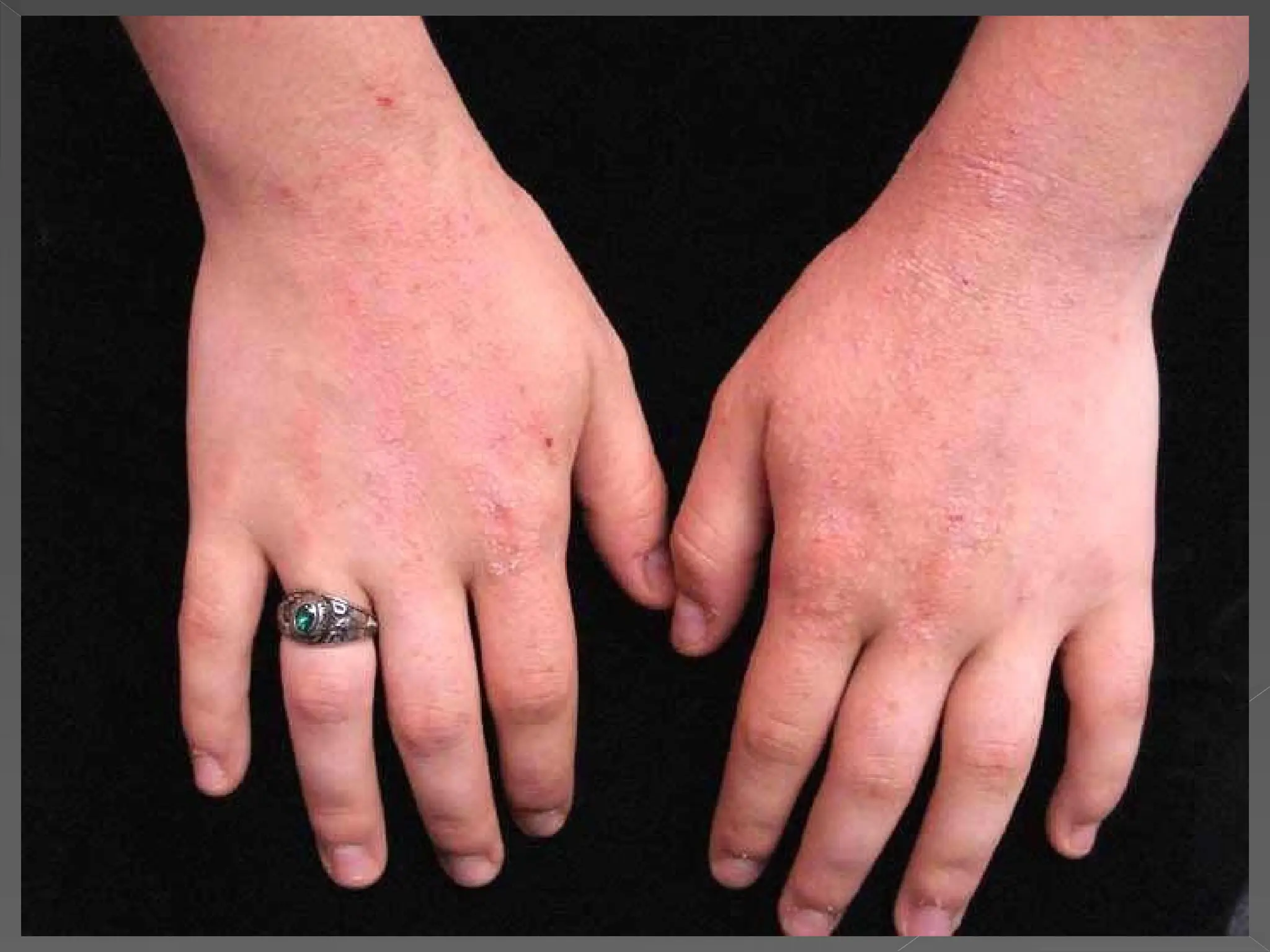 4.Seboorhoeic Dermatitis.pptx by AZIZULLAH Aziz Abdali university | PPT ...