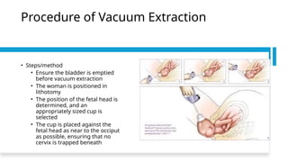 4.24_Vacuum Extraction & Caesarean section_PPT.pptx