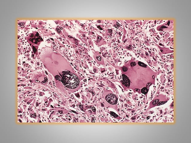 4. neoplasia.ppt for health science students | PPT