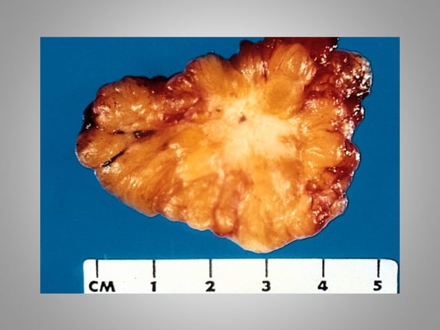 4. neoplasia.ppt for health science students | PPT