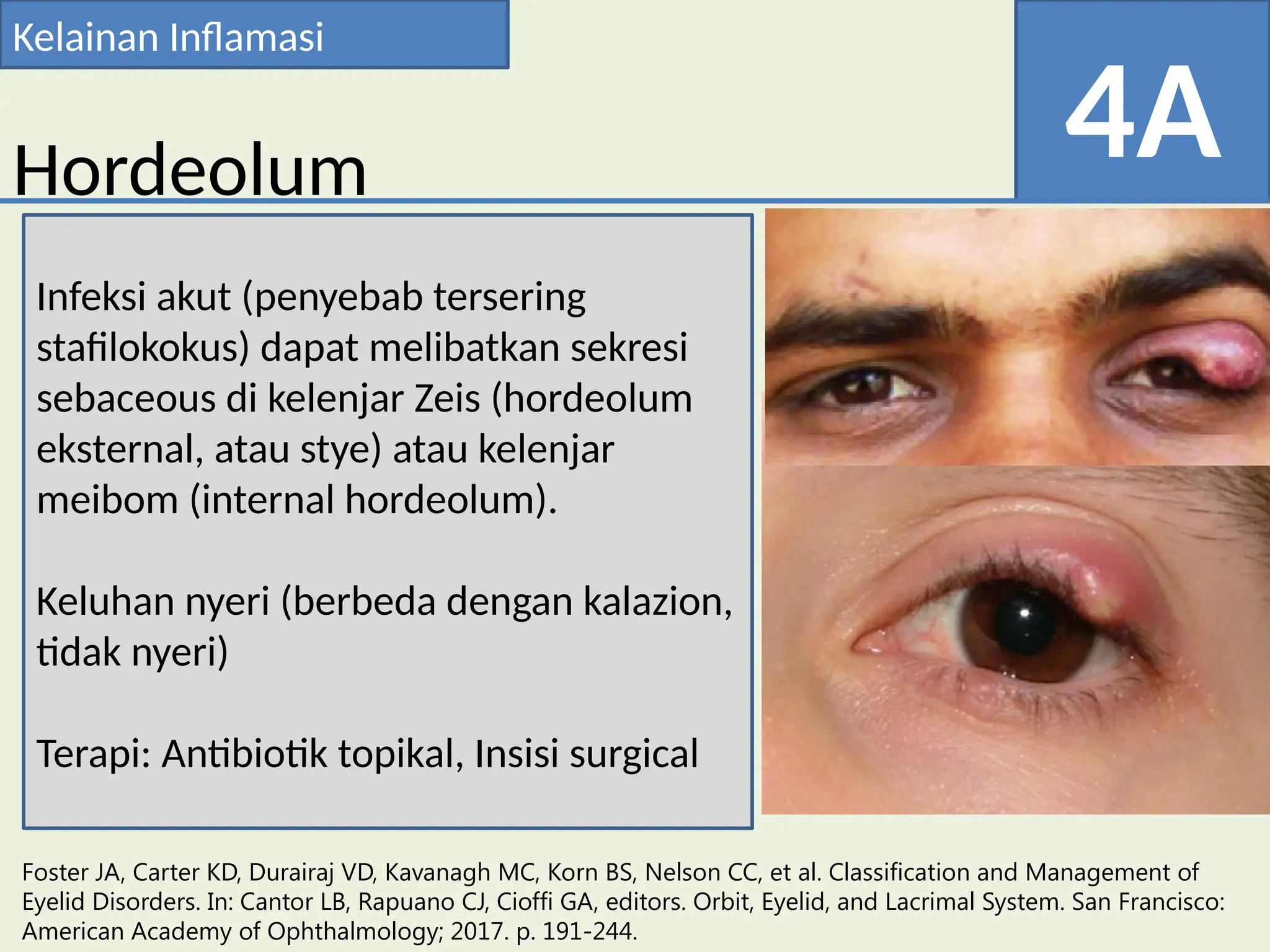 4. Penyakit Palpebra & Adneksa (dr. Halimah, Sp.M) .pptx