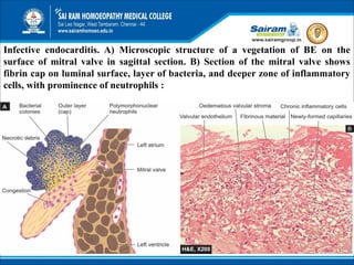 4. infective endocarditis of heart .pptx