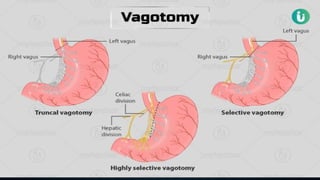 Comprehensive Overview of Peptic Ulcers: Causes, Types, and Management ...