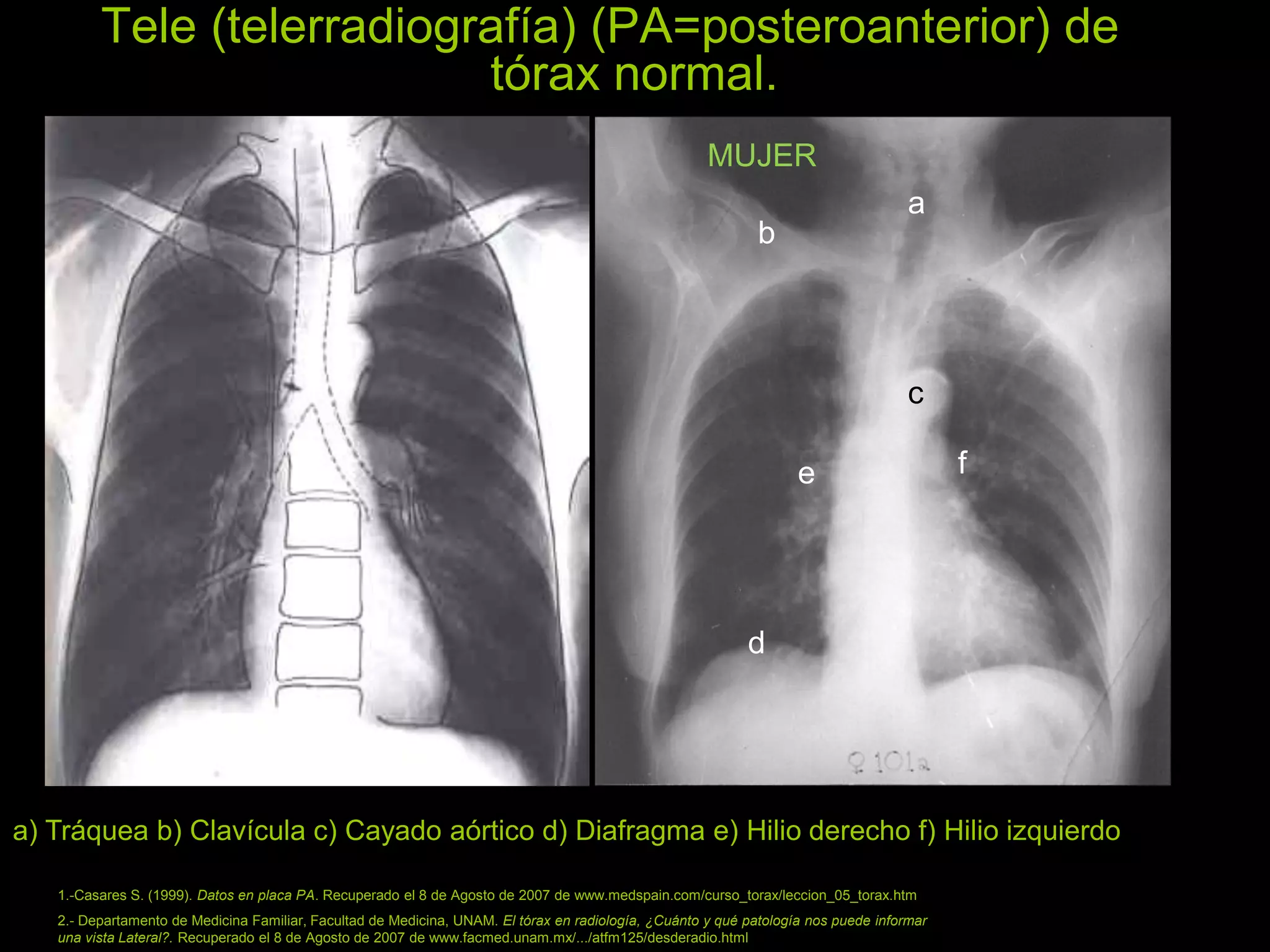 4.2 anatomia descriptiva y radiológica en tele y lateral de tórax | PDF