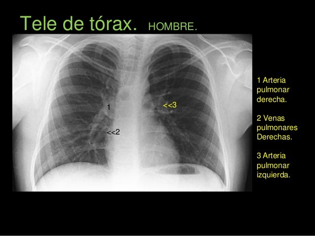 4.2 anatomia descriptiva y radiológica en tele y lateral de tórax