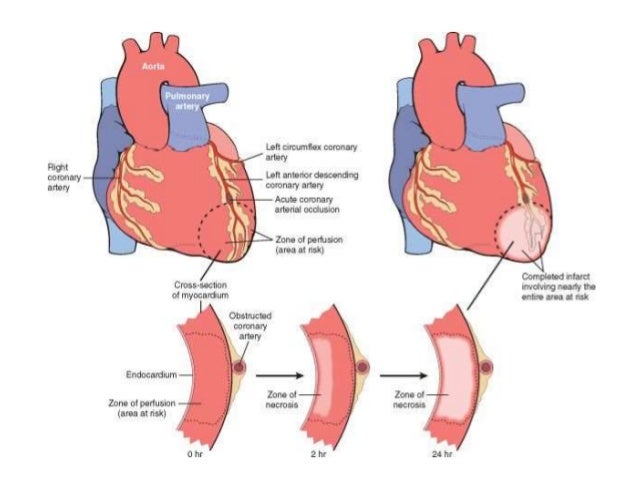 4 4-2016 myocardial infarction