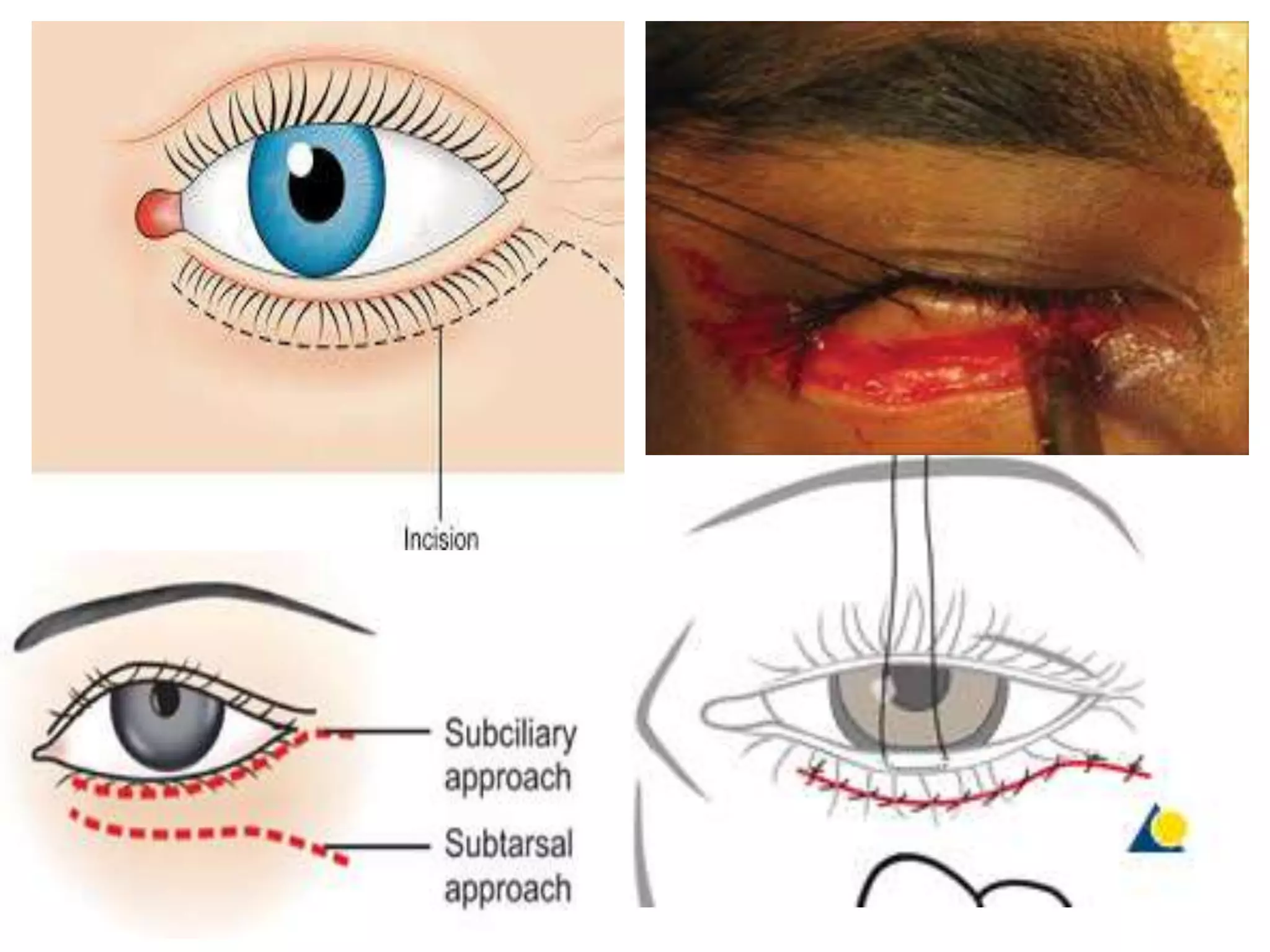Lecture 2 Facial cosmatic surgery | PPTX | Eye and Vision Conditions ...