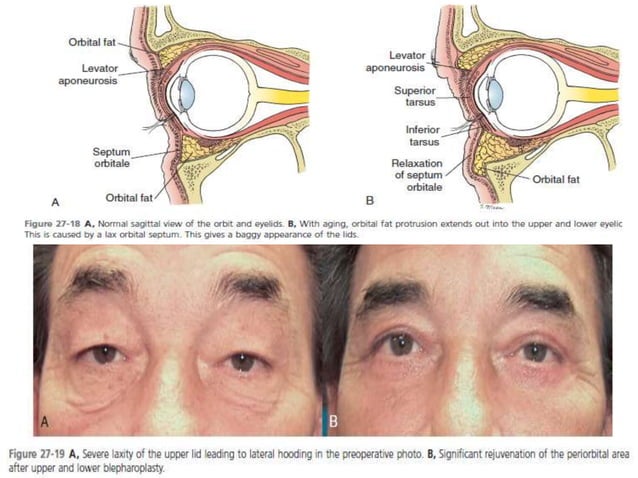 Lecture 2 Facial cosmatic surgery | PPTX | Eye and Vision Conditions ...