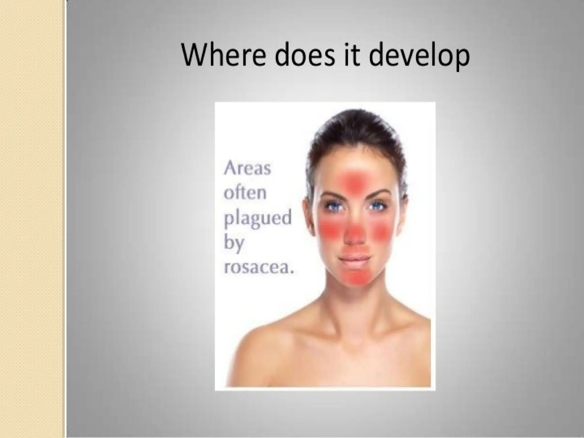 Rosacea is a Latin word meaning (Like-Roses), is an Acne-like rash ...