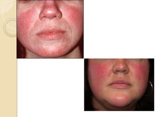 Rosacea is a Latin word meaning (Like-Roses), is an Acne-like rash ...