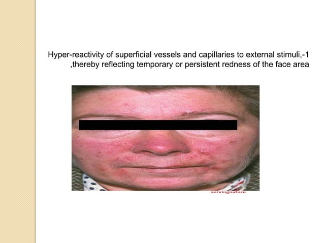 Rosacea is a Latin word meaning (Like-Roses), is an Acne-like rash ...