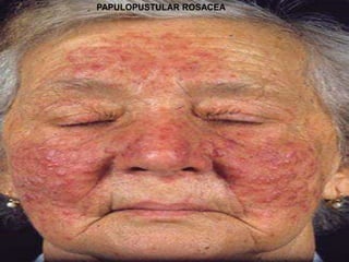 4 acne rosacea (1) | PPT