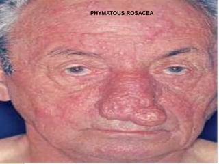 4 acne rosacea (1) | PPT