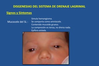 Disgenesias do Sistema de Drenagem Lacrimal - parte I | PPTX