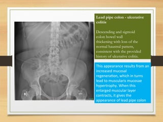 ABDOMINAL XRAYS- BOWEL WALL - BOWEL IN ABNIORMAL SITE. | PPT