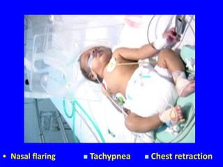 4 bronchiolitis | PPTX