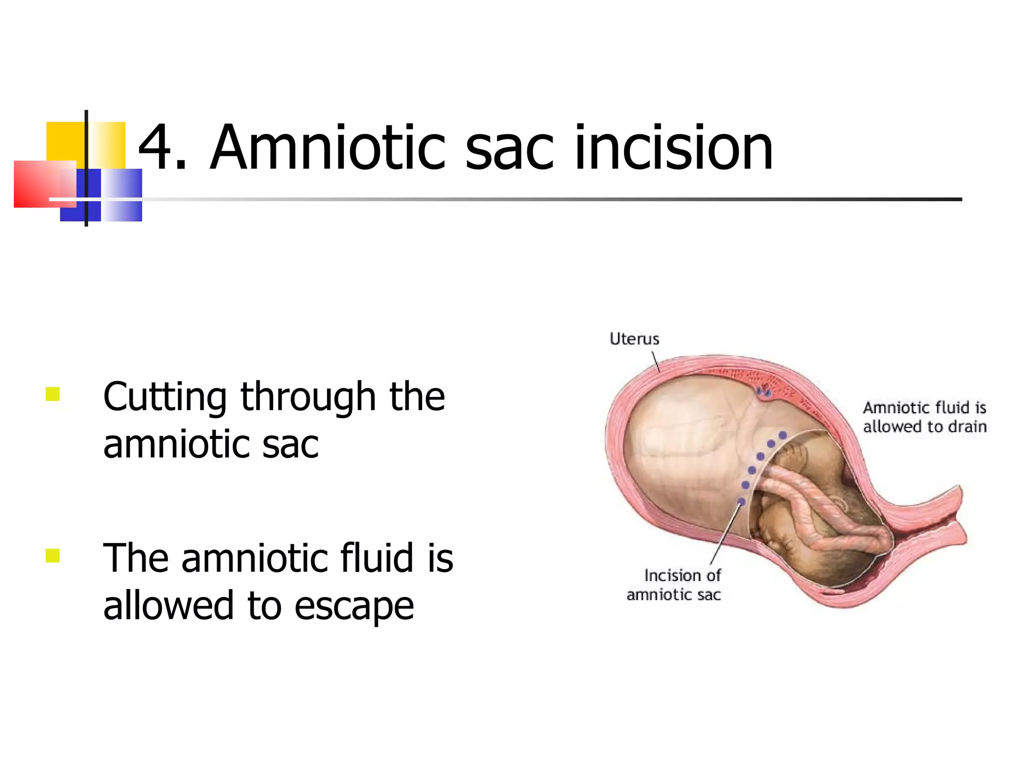 Caesarean section by UM | PPT | Pregnancy | Reproductive Health