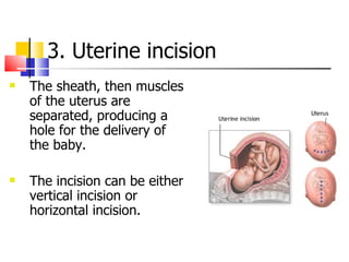 Caesarean section by UM | PPT | Pregnancy | Reproductive Health