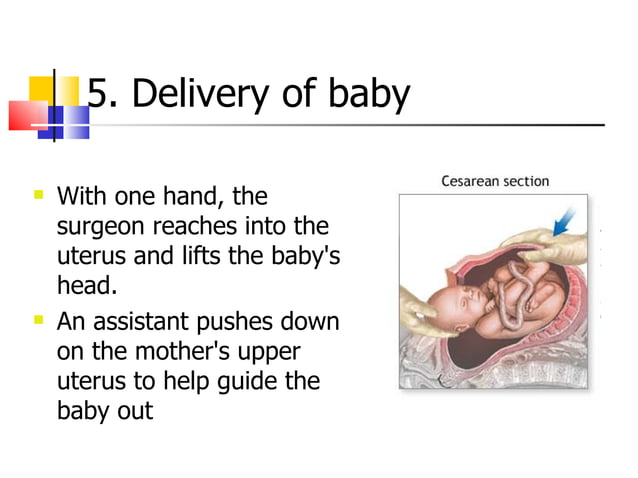 Caesarean section by UM | PPT