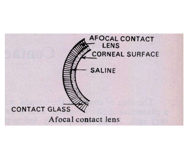 Contact-lenses.ppt