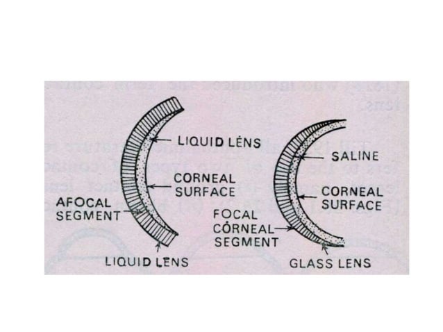 Contact-lenses.ppt