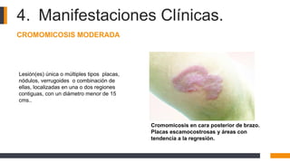 Clase sobre la Cromomicosis en Venezuela.pdf