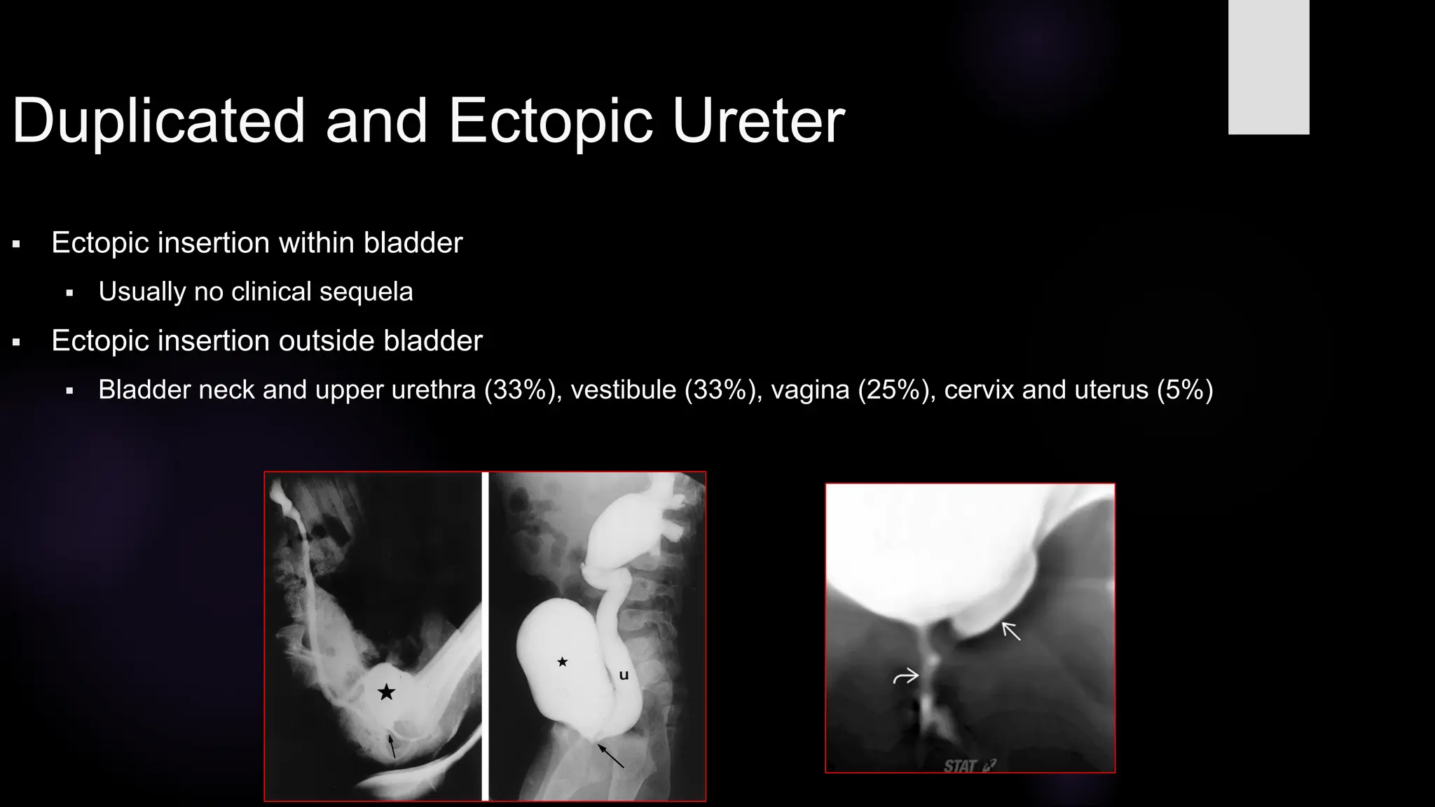 4-disorders of the ureter and urinary bladdder.pdf