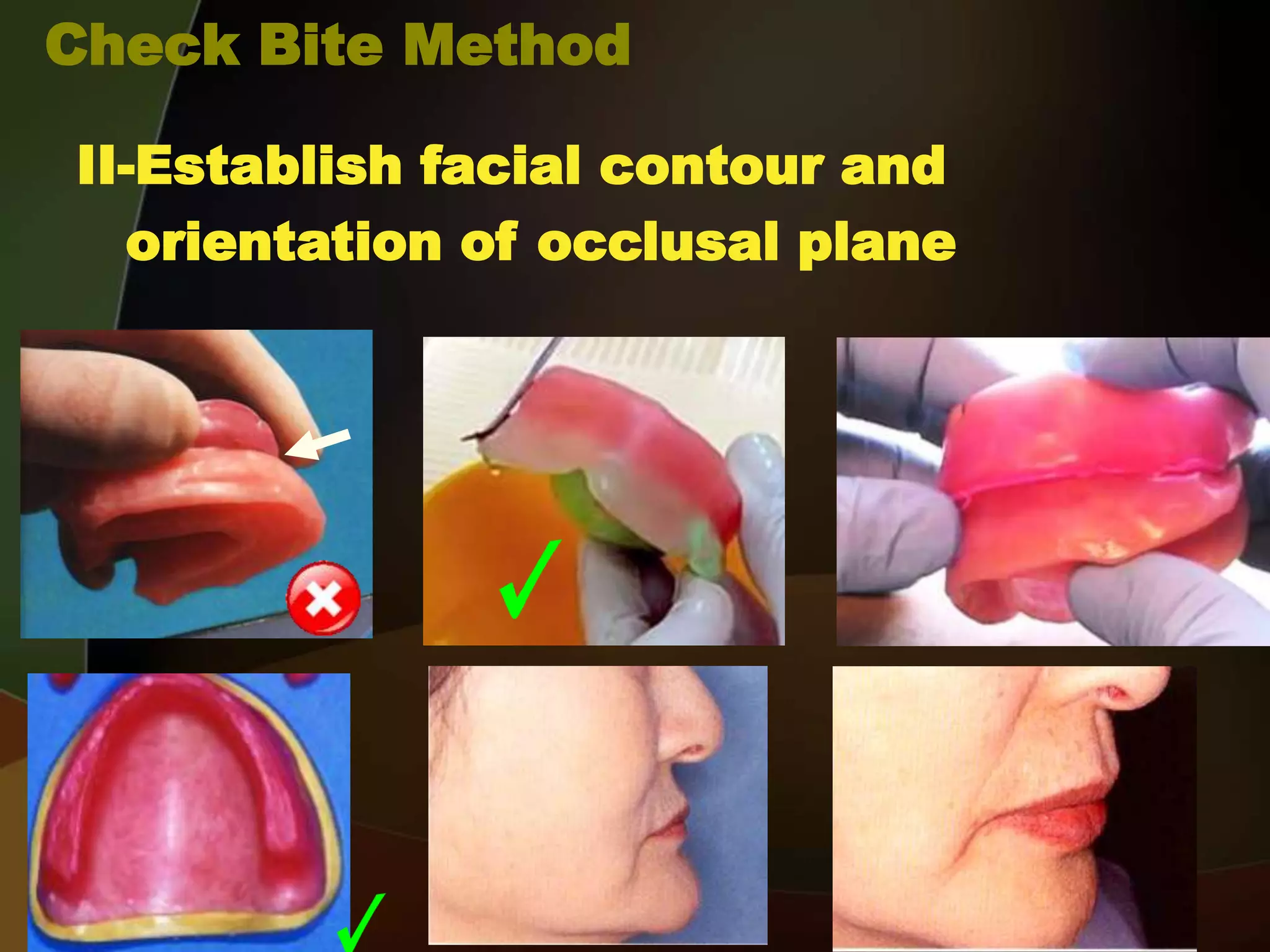 Clinical Steps for Complete Denture Construction 4- Steps of recording jaw relation E- Centric ...