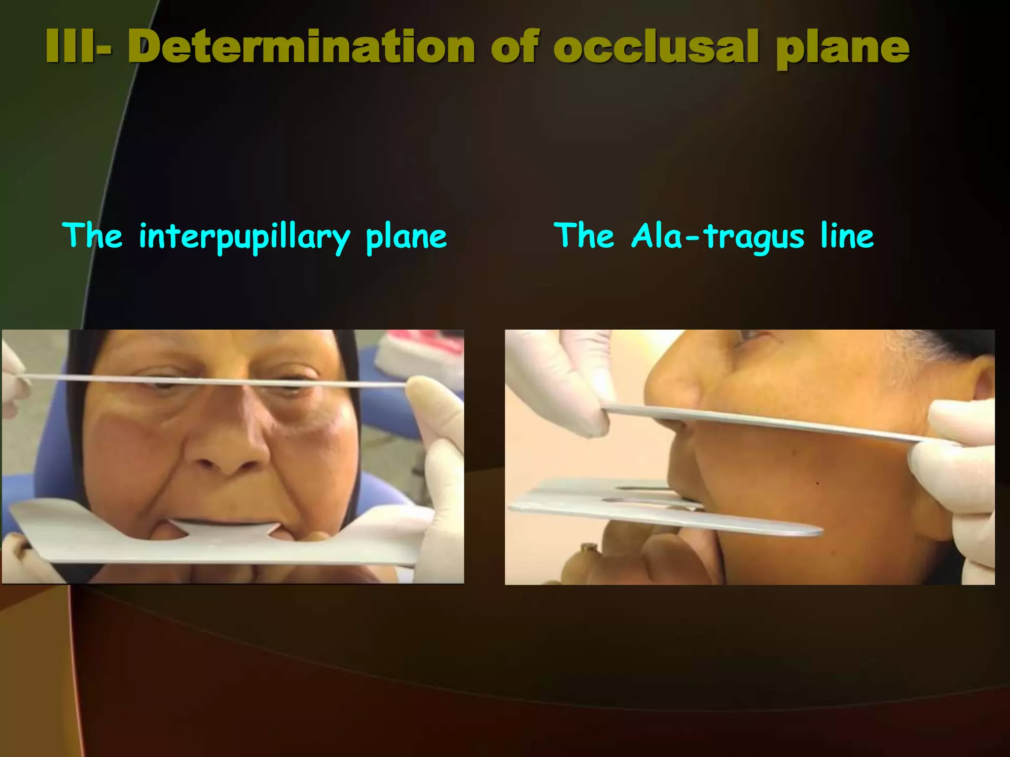 Clinical Steps for Complete Denture Construction 4- Steps of recording ...