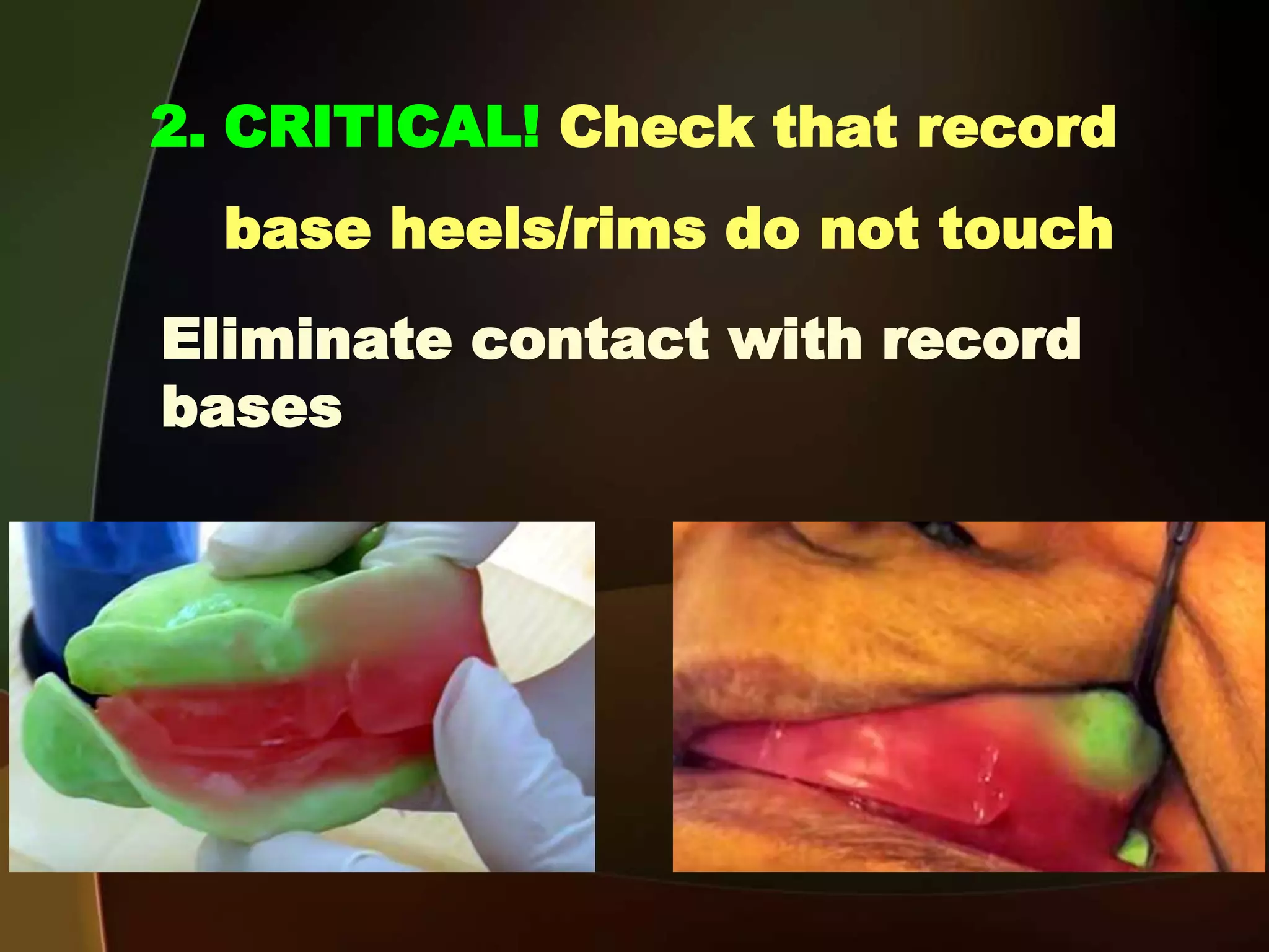 Clinical Steps for Complete Denture Construction 4- Steps of recording ...