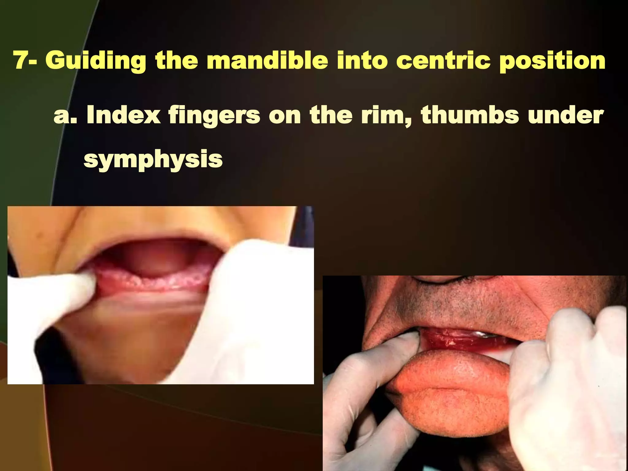 Clinical Steps for Complete Denture Construction 4- Steps of recording jaw relation E- Centric ...