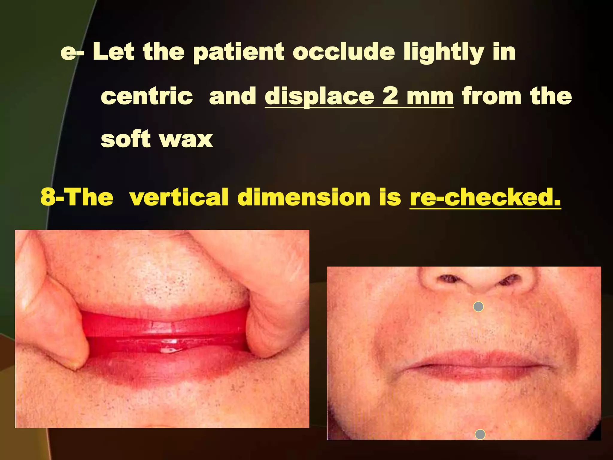 Clinical Steps for Complete Denture Construction 4- Steps of recording ...