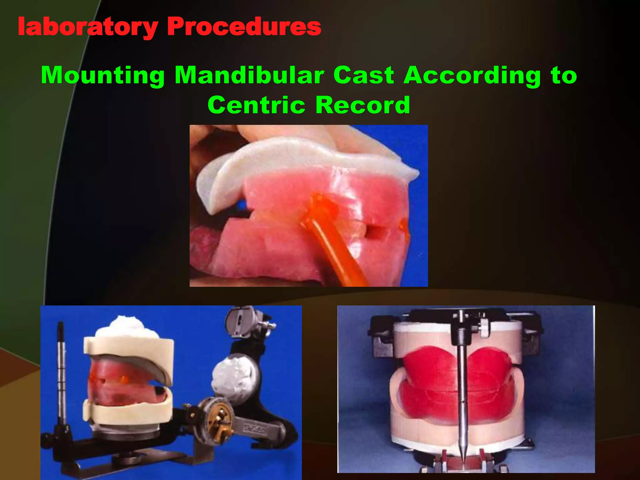 Clinical Steps for Complete Denture Construction 4- Steps of recording ...