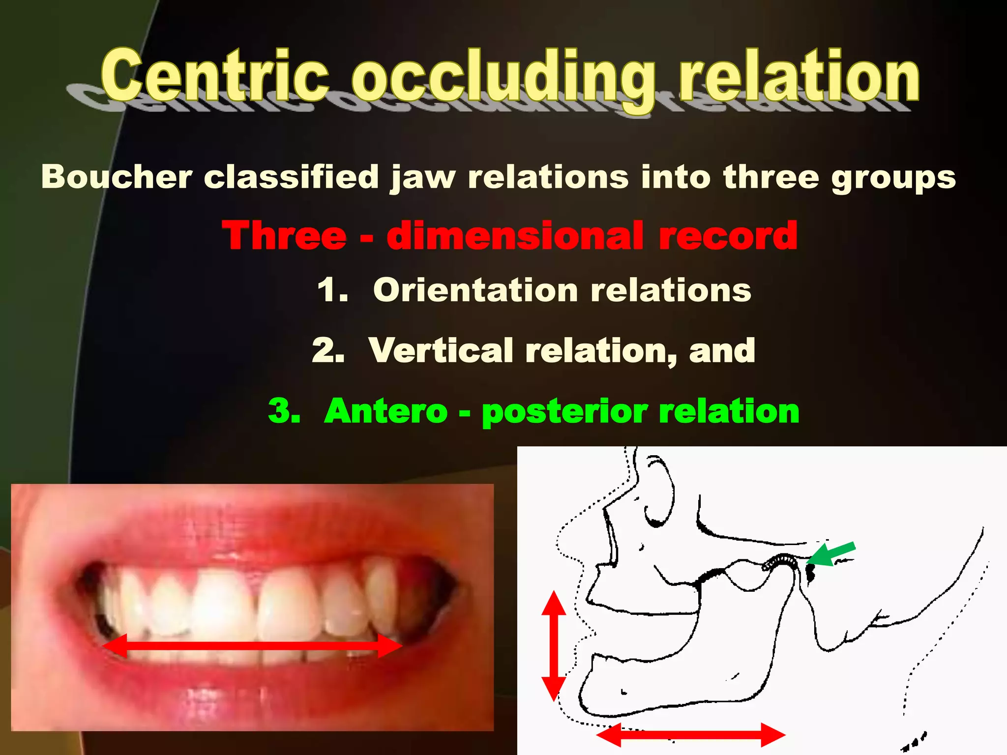 Clinical Steps for Complete Denture Construction 4- Steps of recording jaw relation E- Centric ...